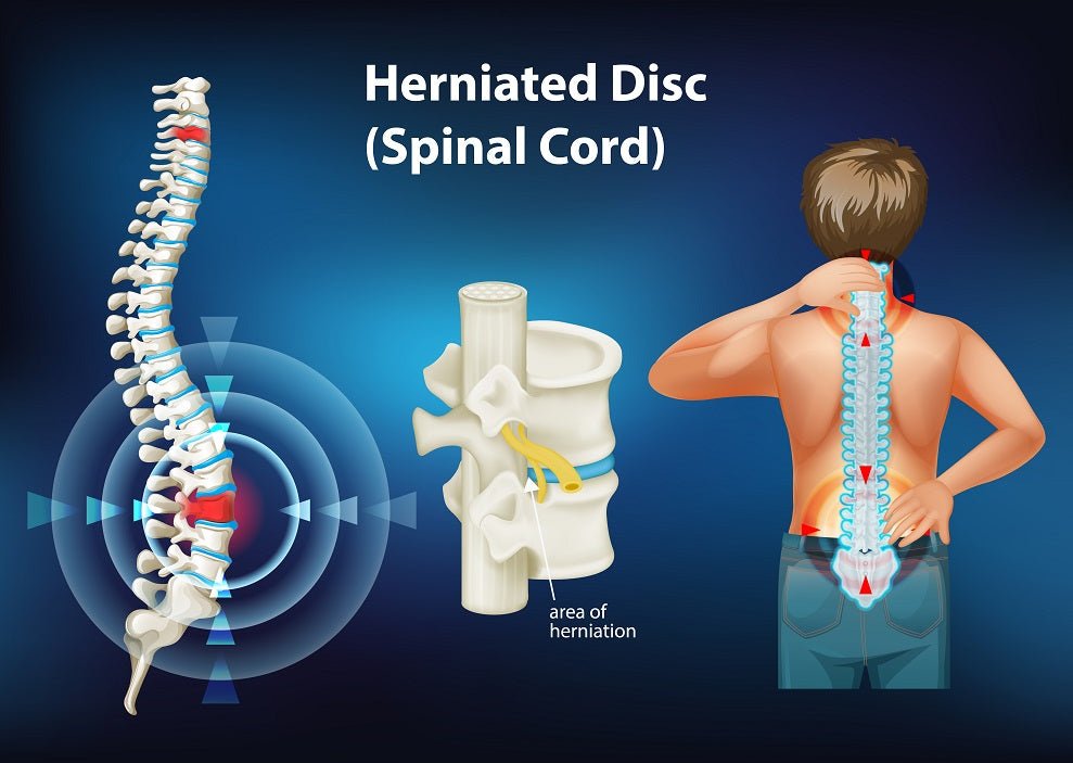 Holistic Ayurveda Treatment for Disc Herniation | Shadanga Kerala ...